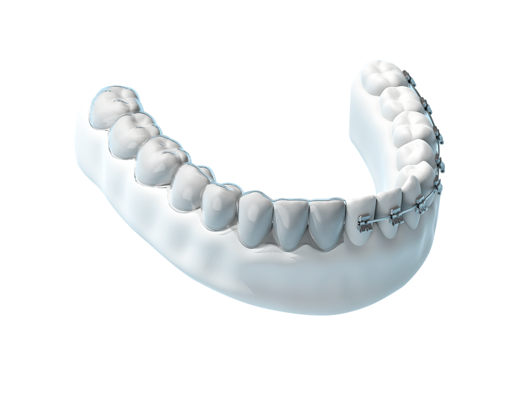 Aligners vs. braces - Ordoline