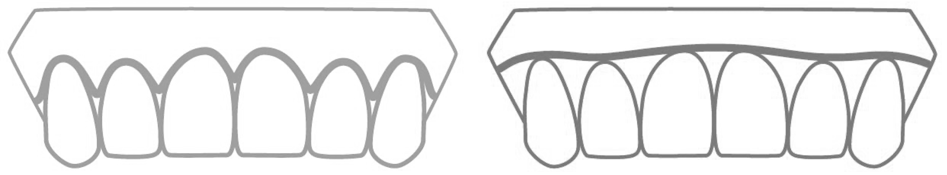 Ordoline 3.0 - Experience the Next Generation Aligner Therapy - Ordoline