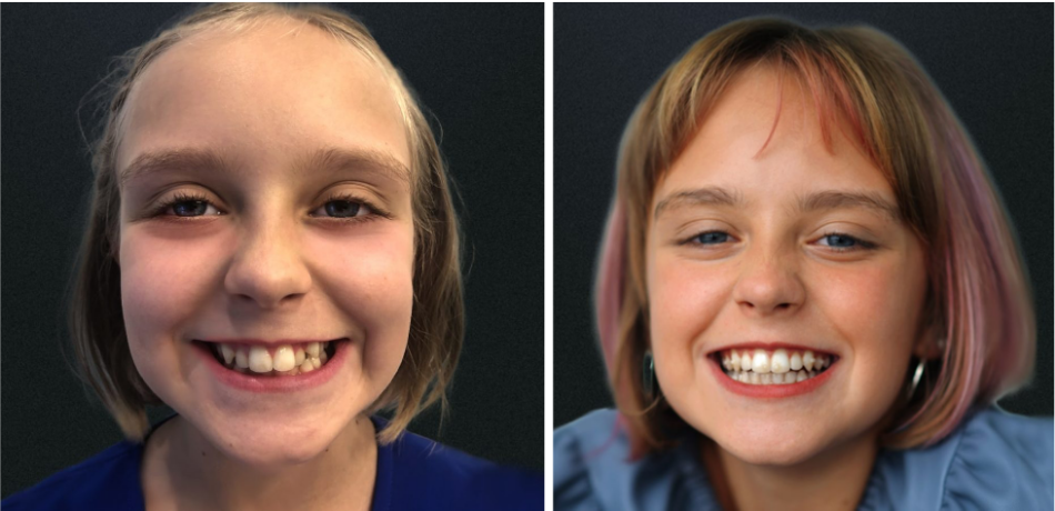 Ordoline 3.0 - Experience the Next Generation Aligner Therapy - Ordoline